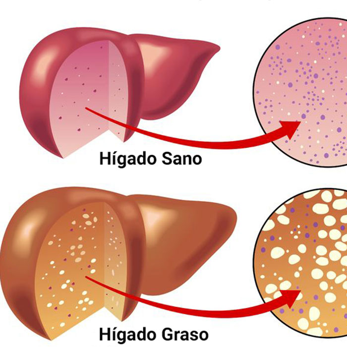 El hígado graso y una salud equilibrada – Escuela Bienestar